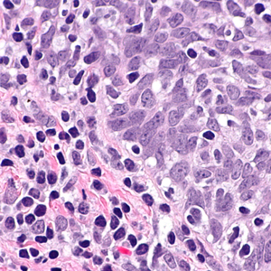 Immunoexpression of p53 mutant-type in Iranian patients with primary ...